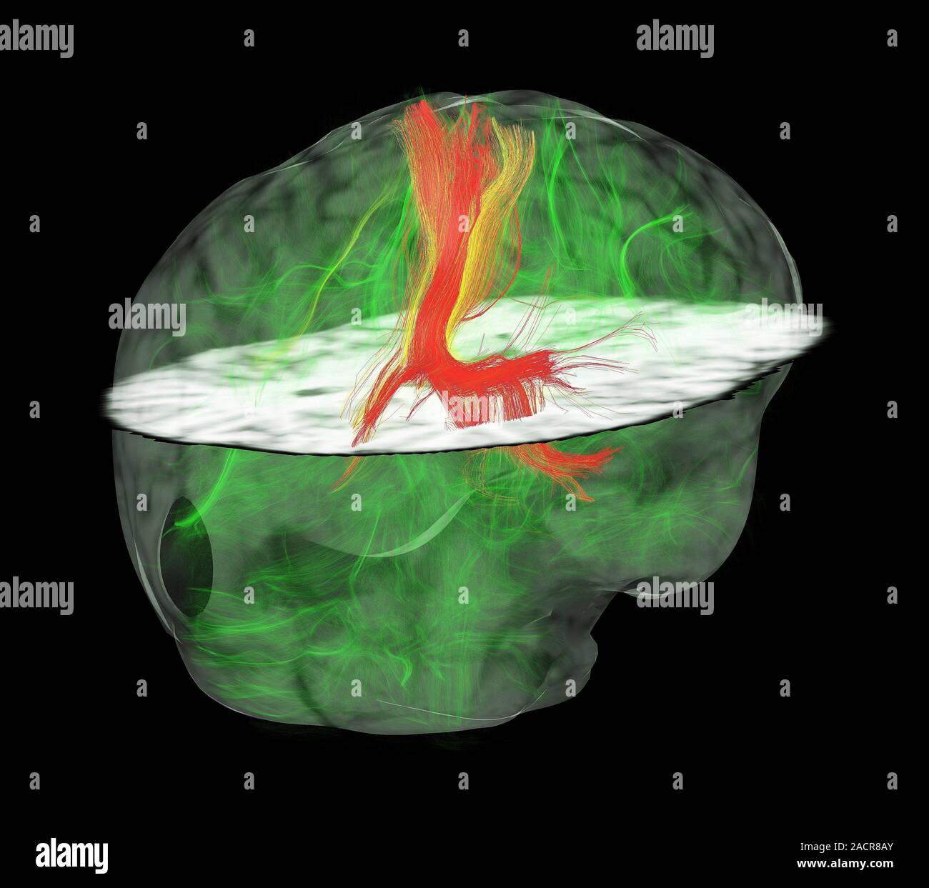 Glioblastome tumeur au cerveau. 3D L'imagerie du tenseur de diffusion (DTI) Imagerie par ...