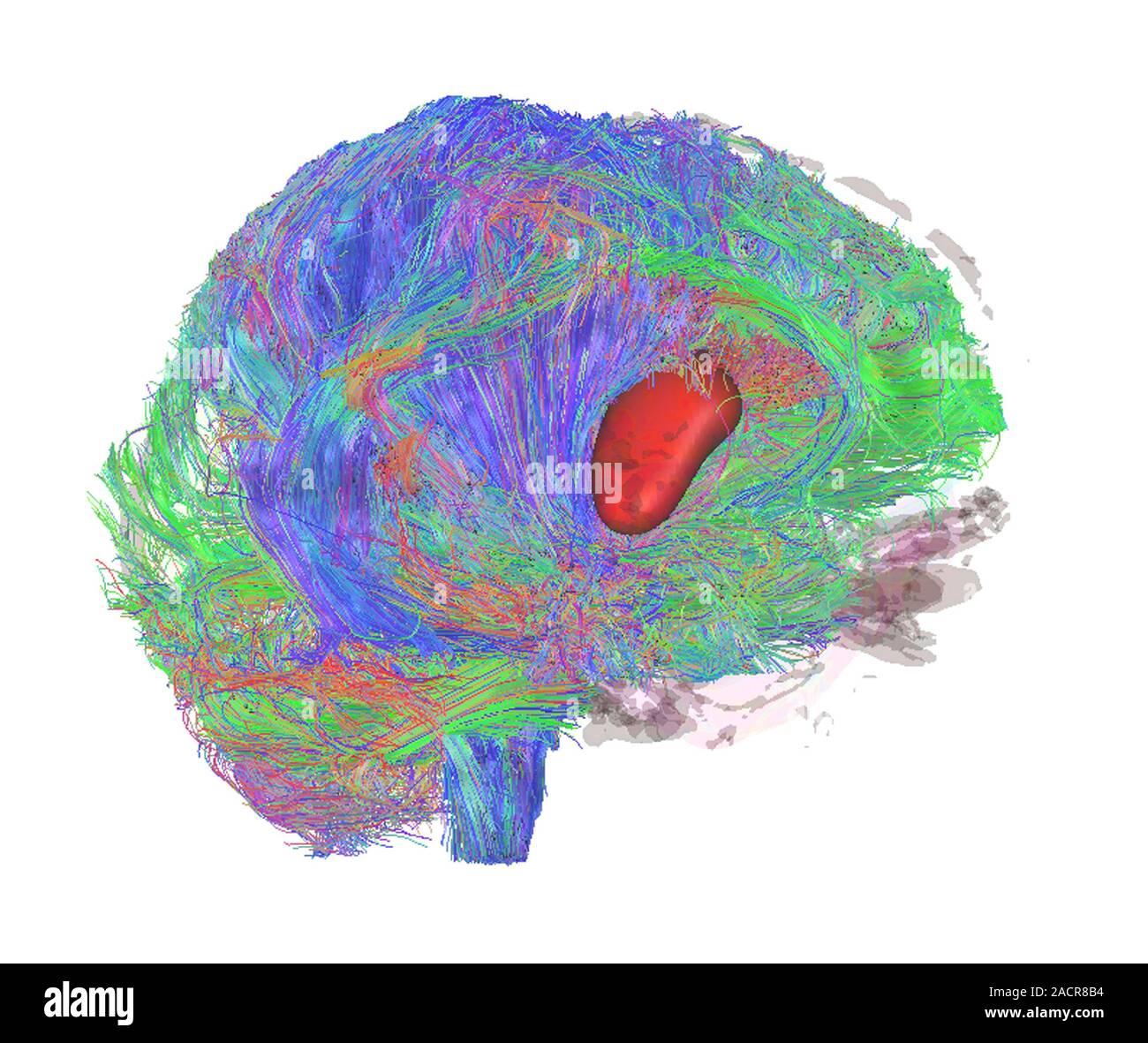 Tumeur au cerveau. 3D L'imagerie du tenseur de diffusion (DTI) Imagerie par résonance magnétique ...