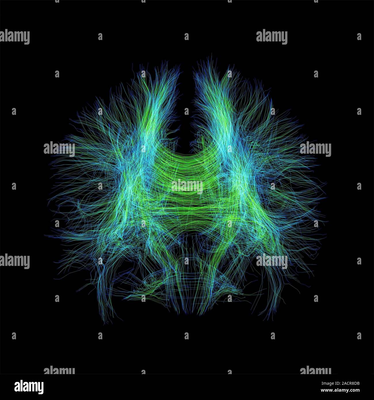 Les fibres du cerveau. 3D L'imagerie du tenseur de diffusion (DTI ...