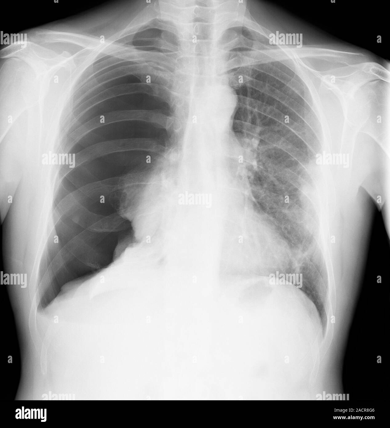 Pneumothorax. X-ray de la poitrine d'un patient de sexe masculin âgé de ...