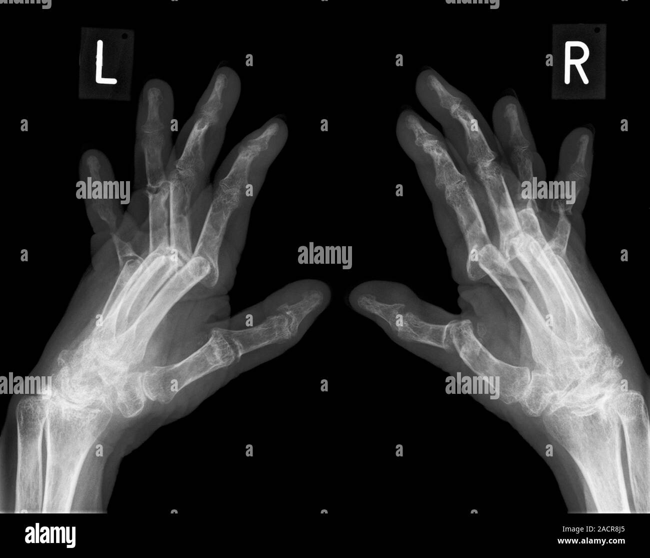 Mains arthritiques. X-ray de la mains et poignets d'un patient âgé de ...