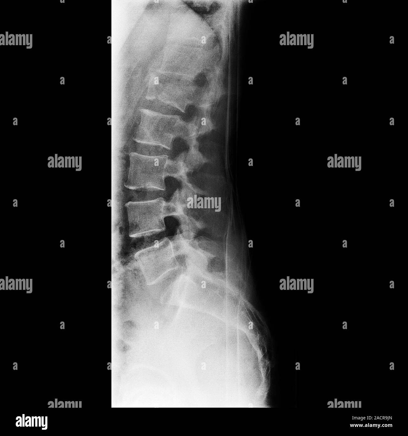 Vertèbre fracturée. X-ray du bas de la colonne vertébrale d'un homme ...