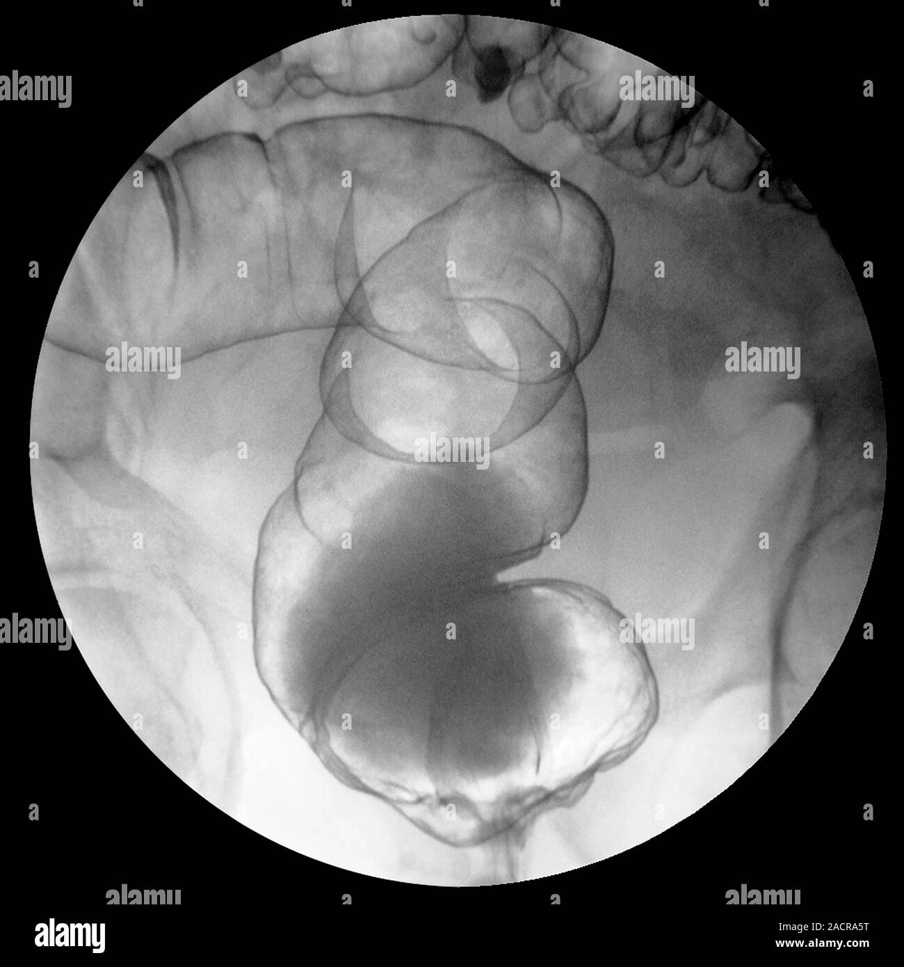 La diverticulite. X-ray du côlon d'un patient atteint de la ...