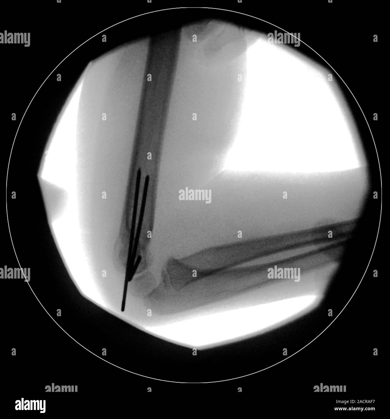 Coude fracturé épinglé. X-ray du coude d'un enfant de 5 ans femelle qui ...