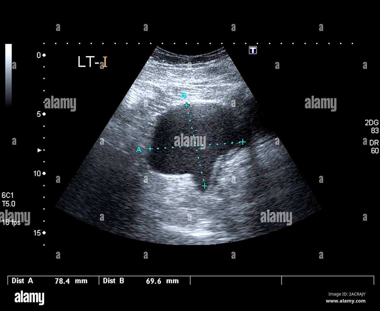 Kystes de l'endomètre. Échographie de la numérisation d'un kyste de l ...