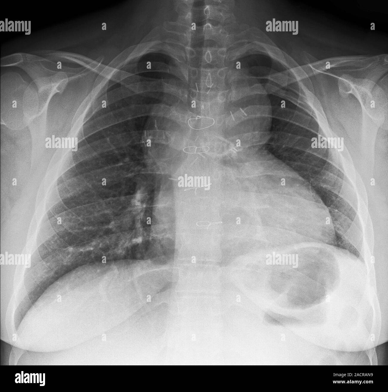 Les maladies cardiaques congénitales. X-ray de la poitrine d'une femme ...