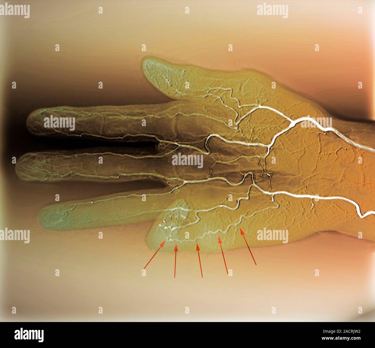L'approvisionnement en sang de la main. Angiogramme de couleur (X-ray ...