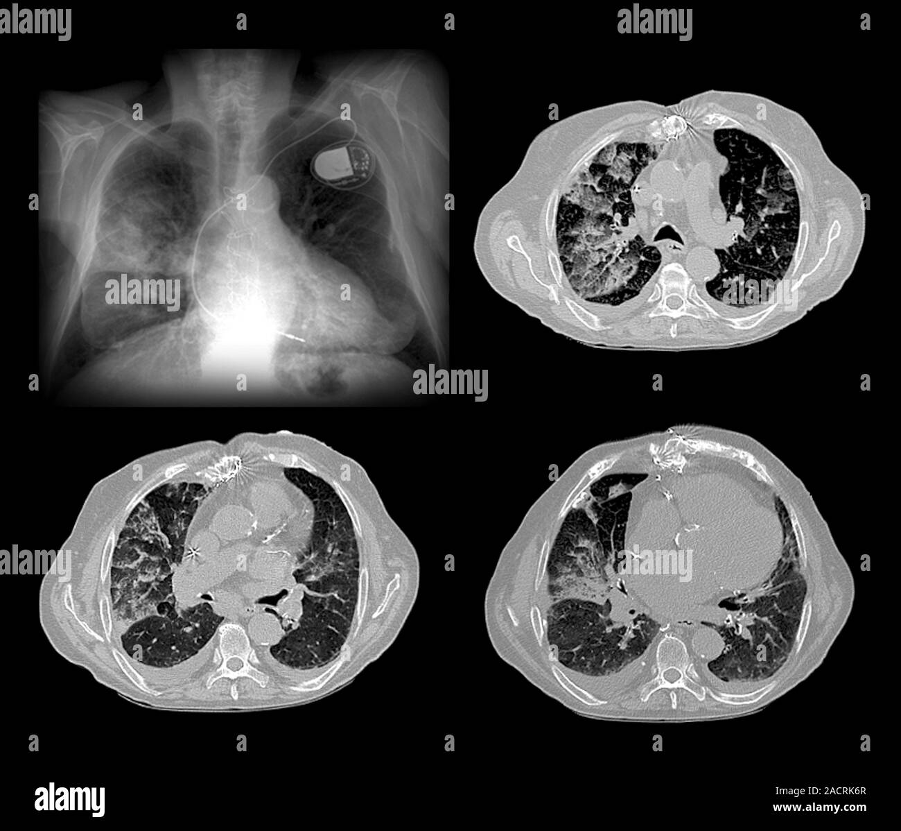 Les maladies cardiaques et pulmonaires. X-ray (en haut à gauche) et de ...