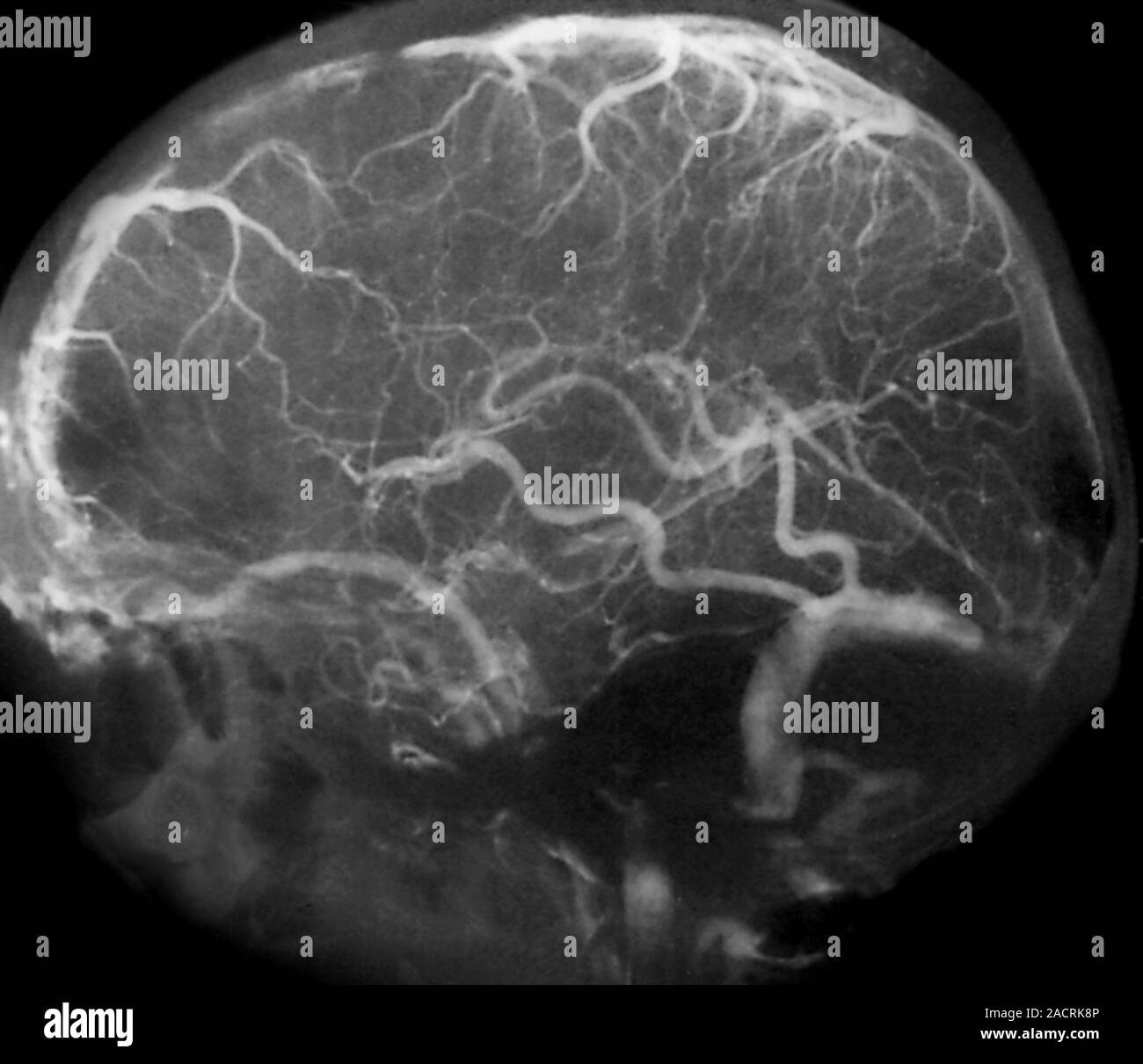Thrombophlébite. Angiogramme (rayons X) du cerveau d'une femme de 28 ...