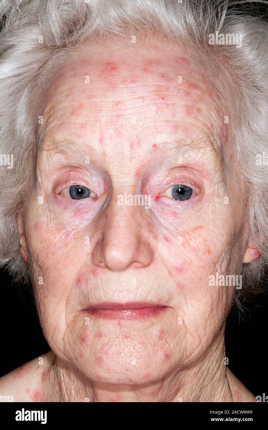 La varicelle. Les éruptions de varicelle sur la face d'un 85-year-old ...