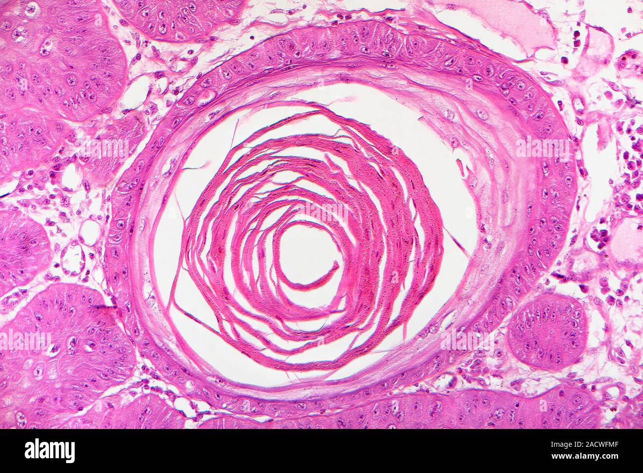 Le cancer de l'œsophage. Micrograph Light d'une biopsie de l'œsophage ...