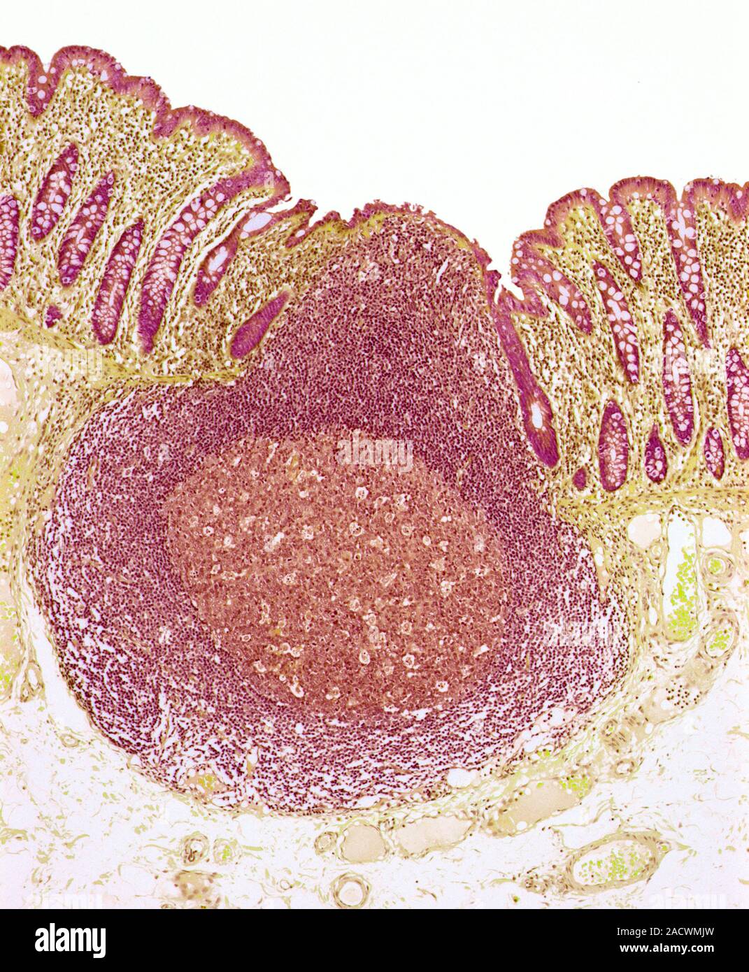 La maladie de Crohn. Microphotographie lumière d'une section par un ...