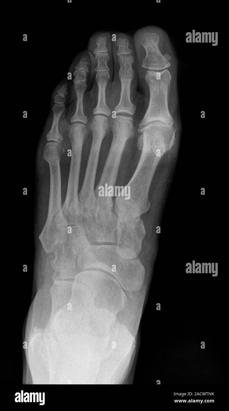 L'arthrite du pied. X-ray du pied gauche d'une femme de 60 ans ...