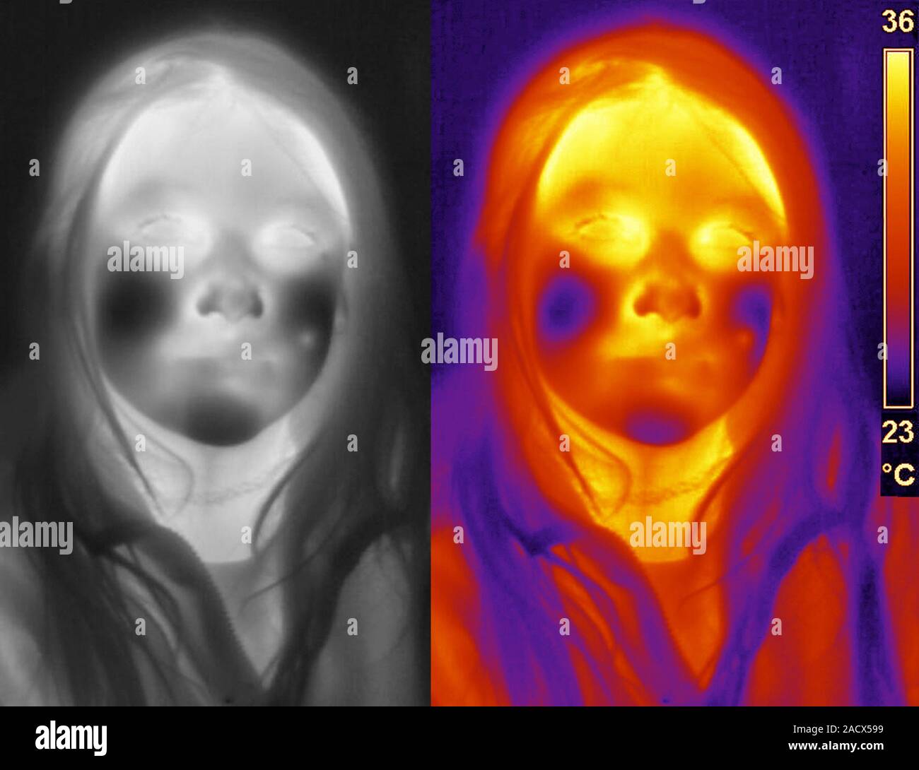Visage de la fille, thermogramme. Un thermogramme montre la variation ...