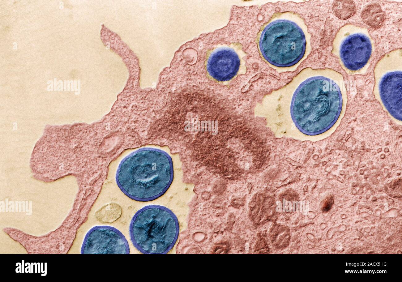 Maladie de Papillon-Lefèvre syndrome. Micrographe de couleur (TEM) d ...