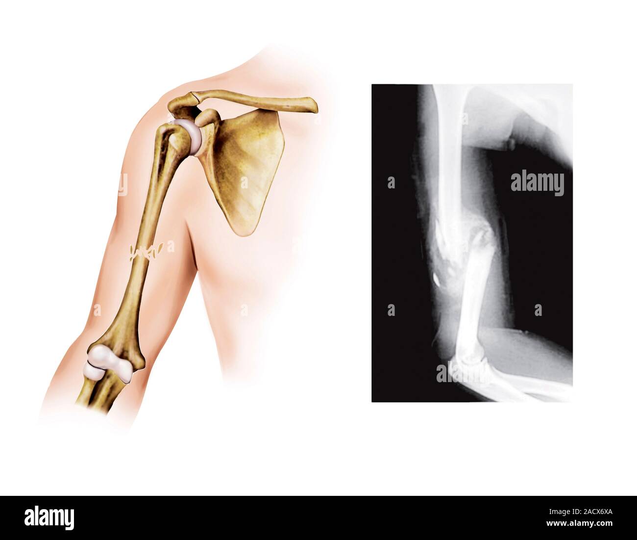 Illustration des types de fractures osseuses, fracture comminutive ...