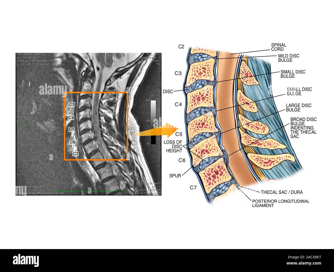 Les disques d'enflement dans le rachis cervical. Art et étiqueté ...