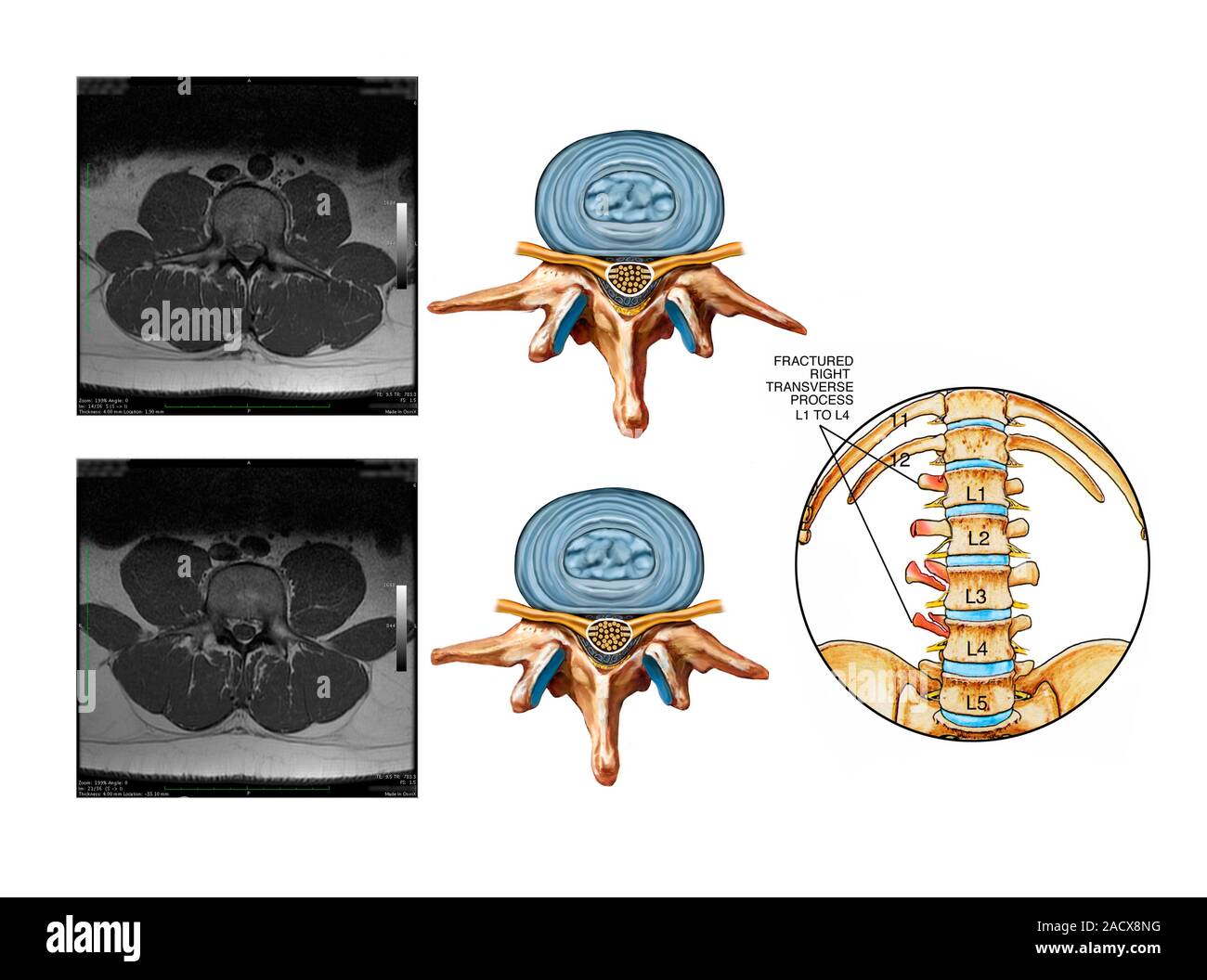 Fracture vertébrale lombaire les processus. Œuvres et étiqueté axial ...