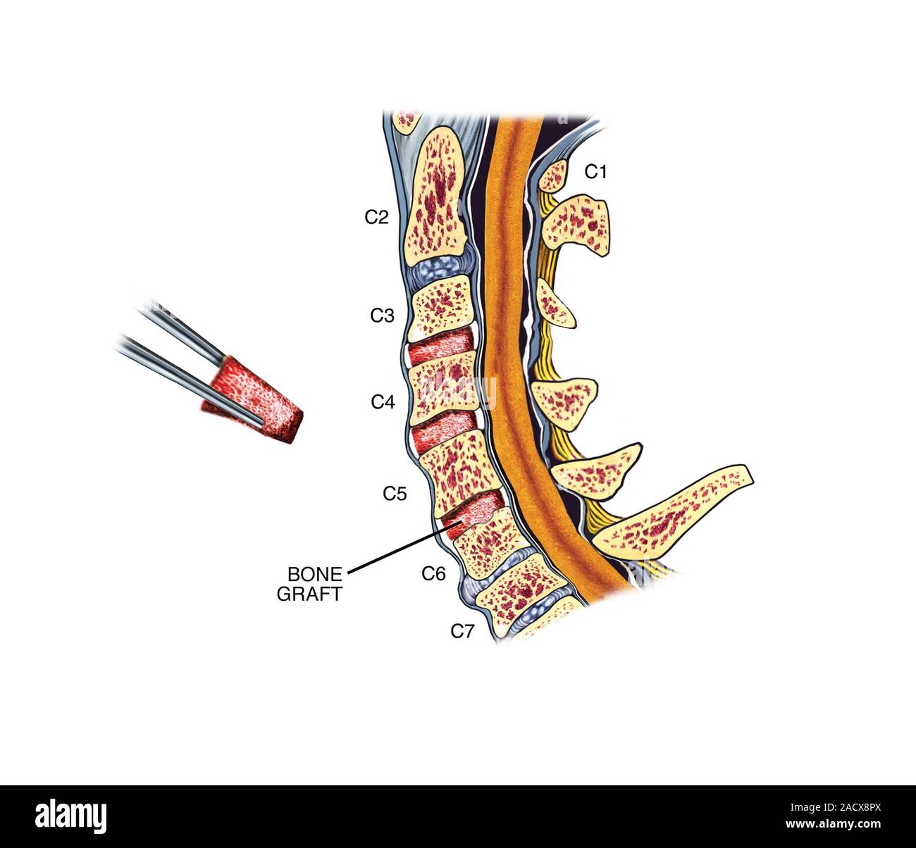Greffe Osseuse pour restaurer l'épine cervicale. L'oeuvre l'étiquette ...
