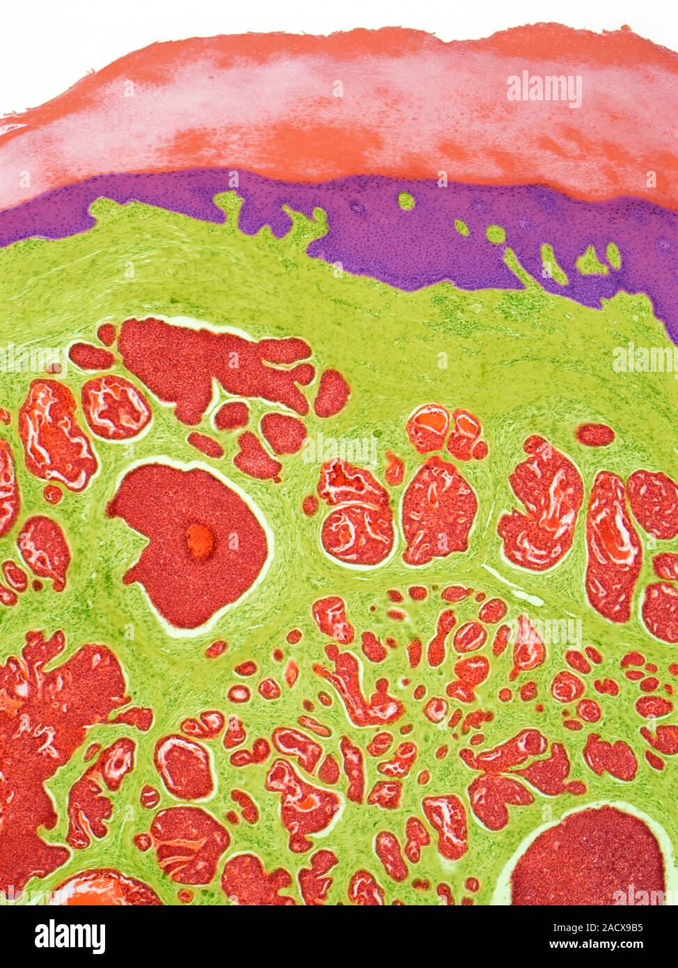 Adénome papillaire Digital micrograph light, d'une section de peau ...