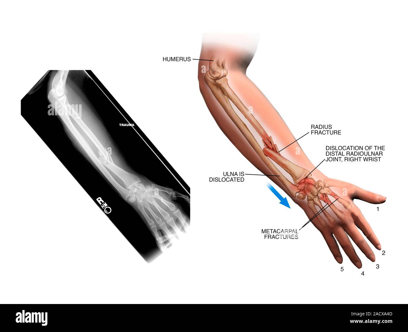Fracture des os du bras et de la main. La mention d'art et de rayons X ...