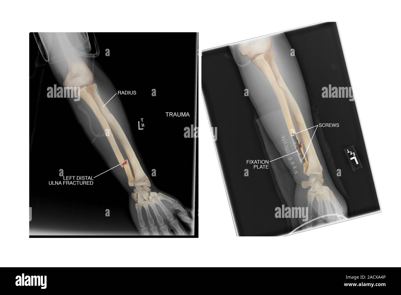 Fracture de l'os ulna et fixation. Des rayons x d'une fracture du ...