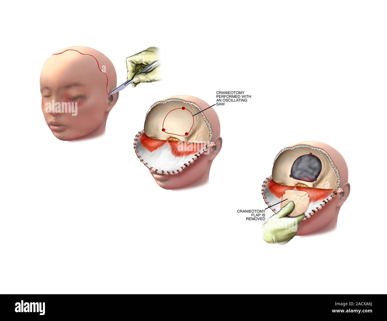 Chirurgie pour fracture du crâne. Séquence de l'oeuvre montrant étapes ...