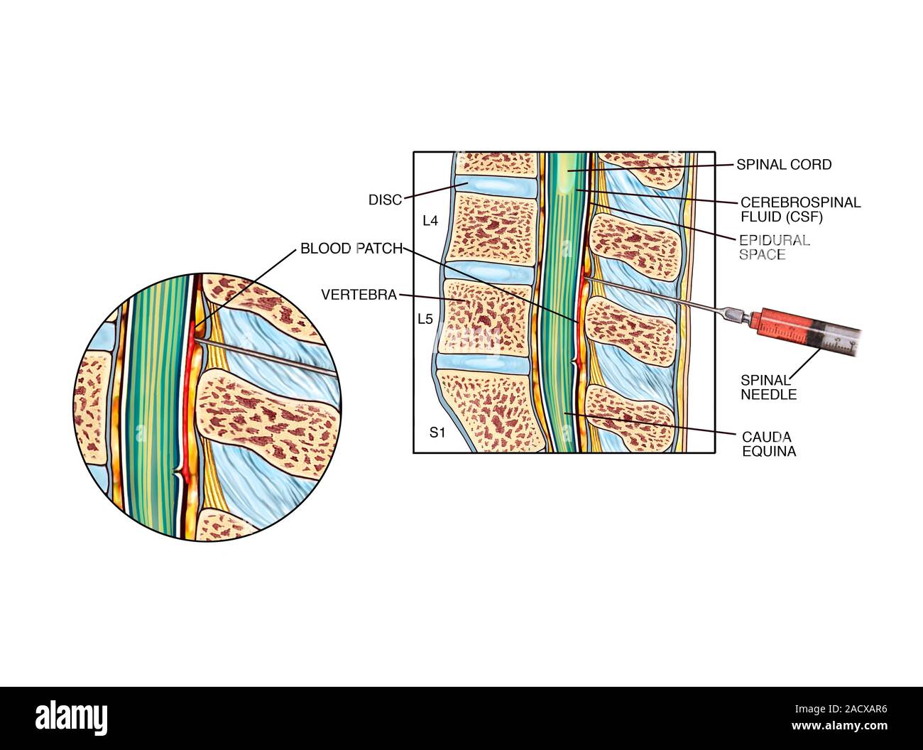 Patch sang épidural. La mention de l'oeuvre d'une pièce étant injecté ...