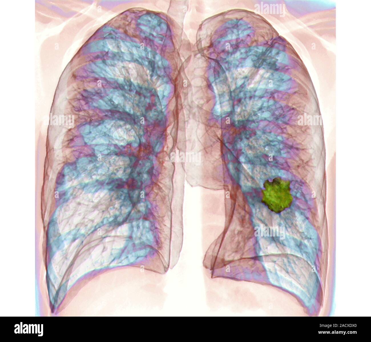 Le cancer du poumon. Frontal de couleur 3D computed tomography (CT) d ...