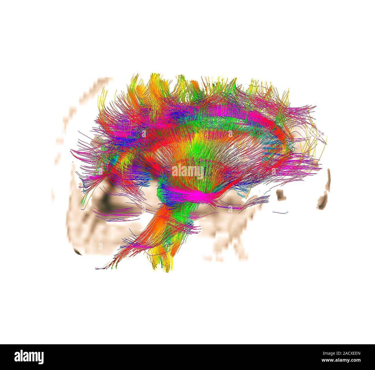 Les fibres de la matière blanche. L'imagerie du tenseur de diffusion de ...