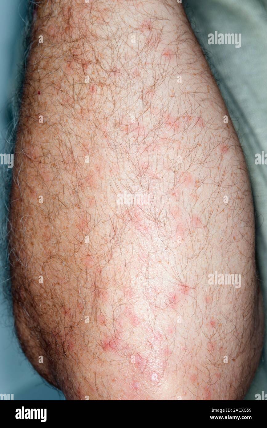 Les piqûres de moucherons (points rouges) sur l'avant-bras d'un pêcheur ...