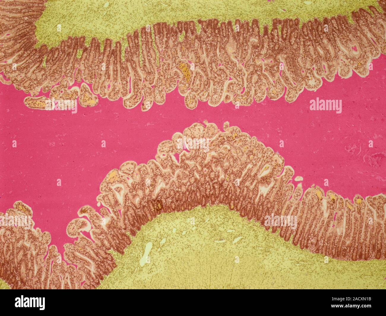 La fibrose kystique. La lumière microphotographie (LM) d'un intestin ...