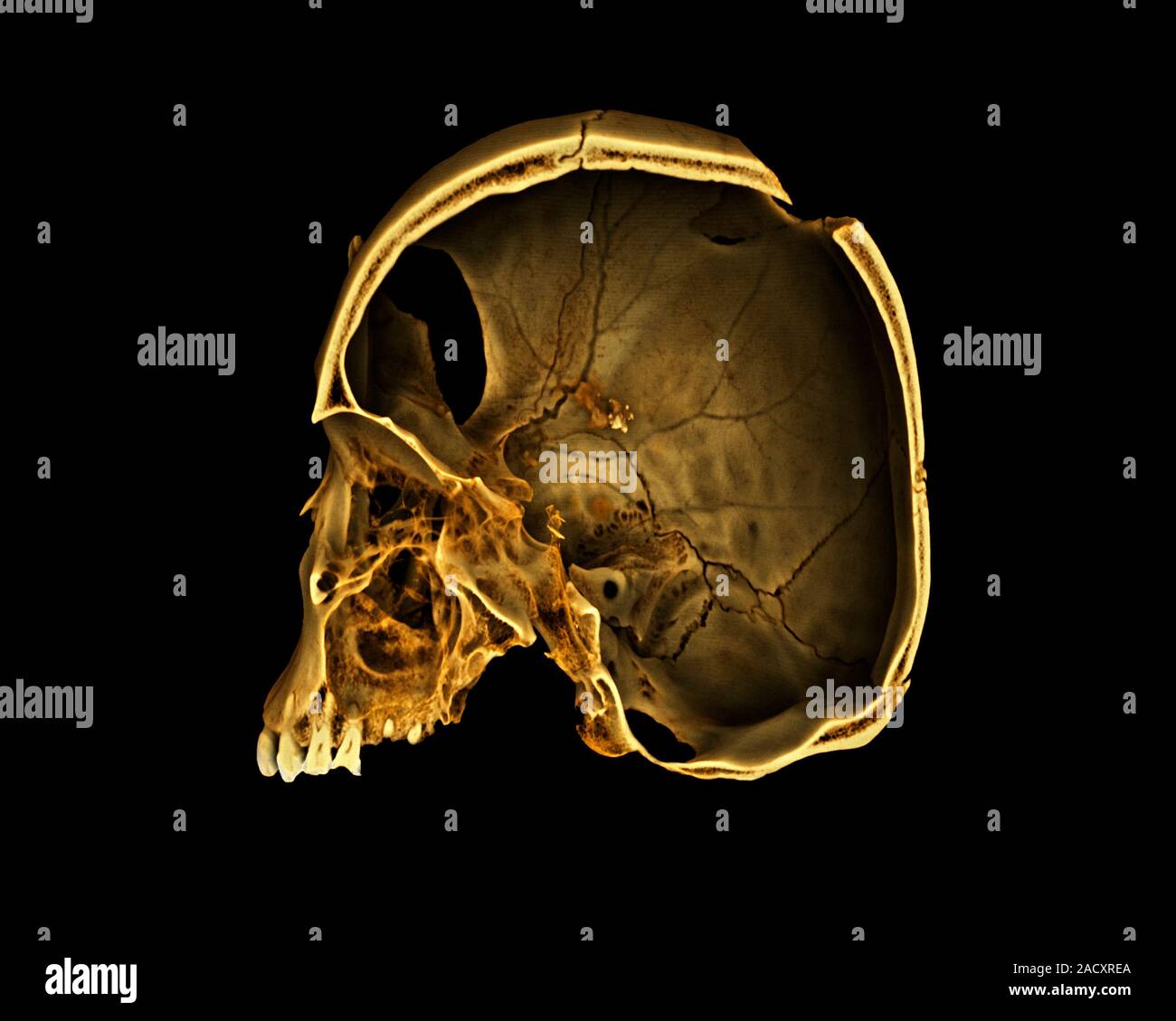 Crâne nubien, micro-CT scan. Cette section présente les 2 000 ans de ...