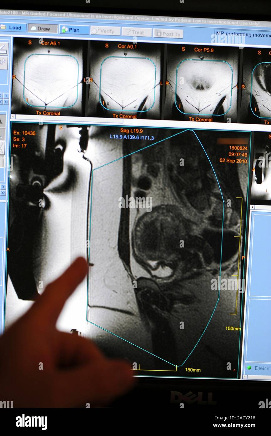 Réalisé par IRM des fibromes par ultrasons. L'imagerie par résonance ...