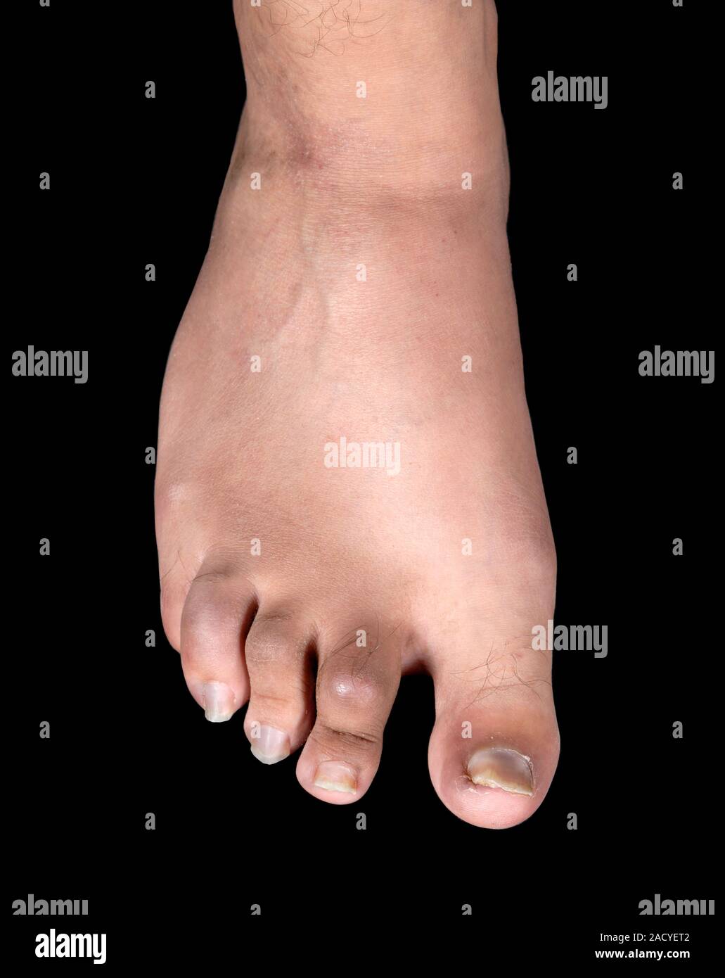 Rhumatisme psoriasique sur un pied du patient. L'arthrite psoriasique ...