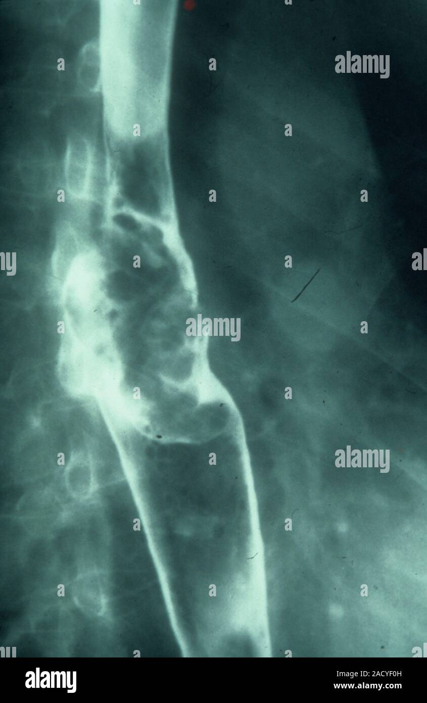 Le cancer de l'œsophage. Radiographie d'un patient avec une tumeur ...