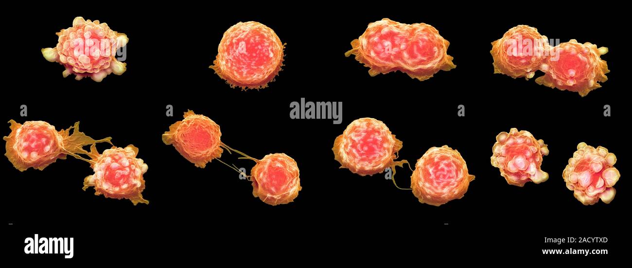 La division des cellules du cancer colorectal. Couleur de l'analyse des ...