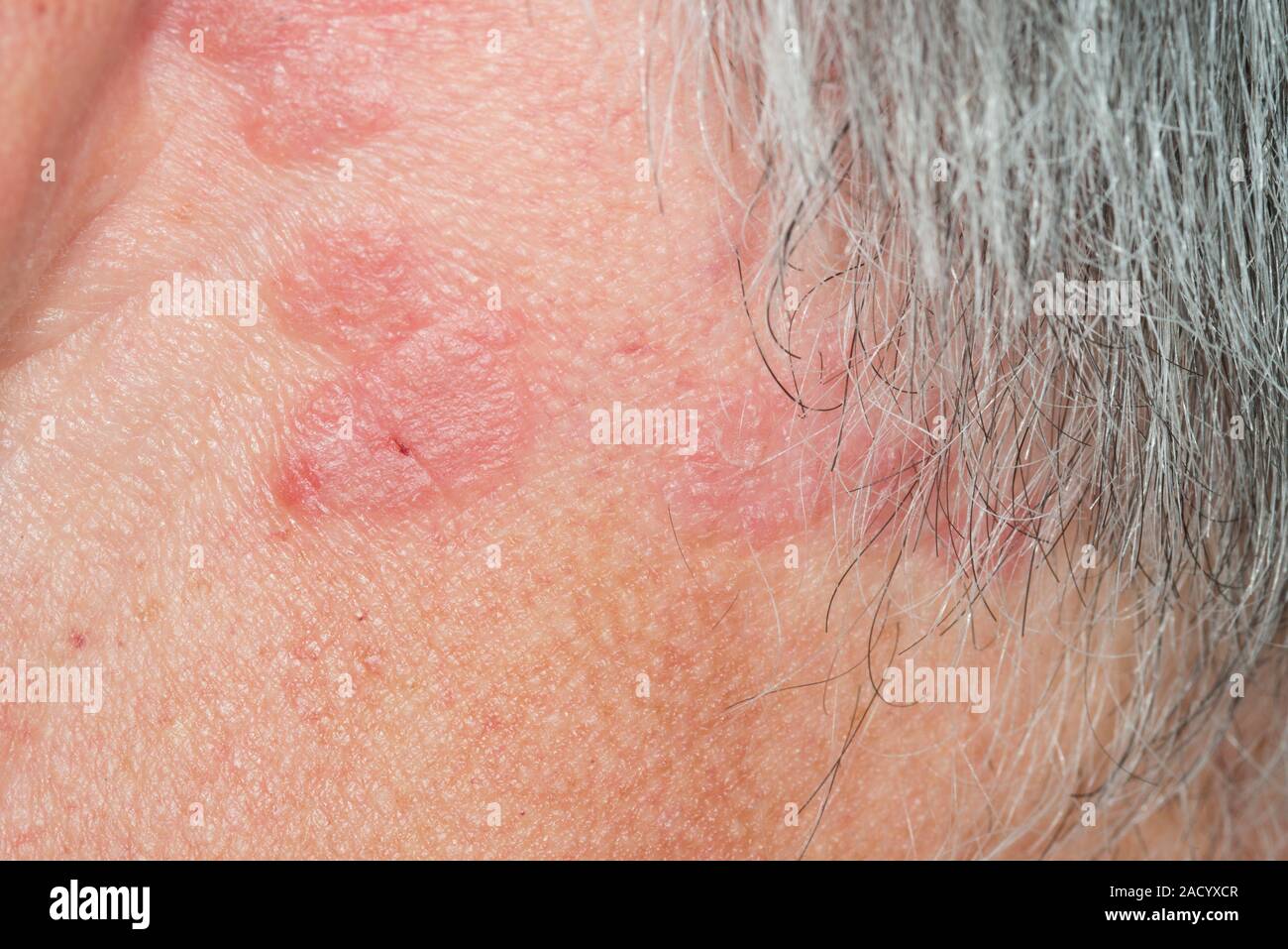 Le psoriasis du cuir chevelu. Close-up du psoriasis sur le cuir chevelu ...