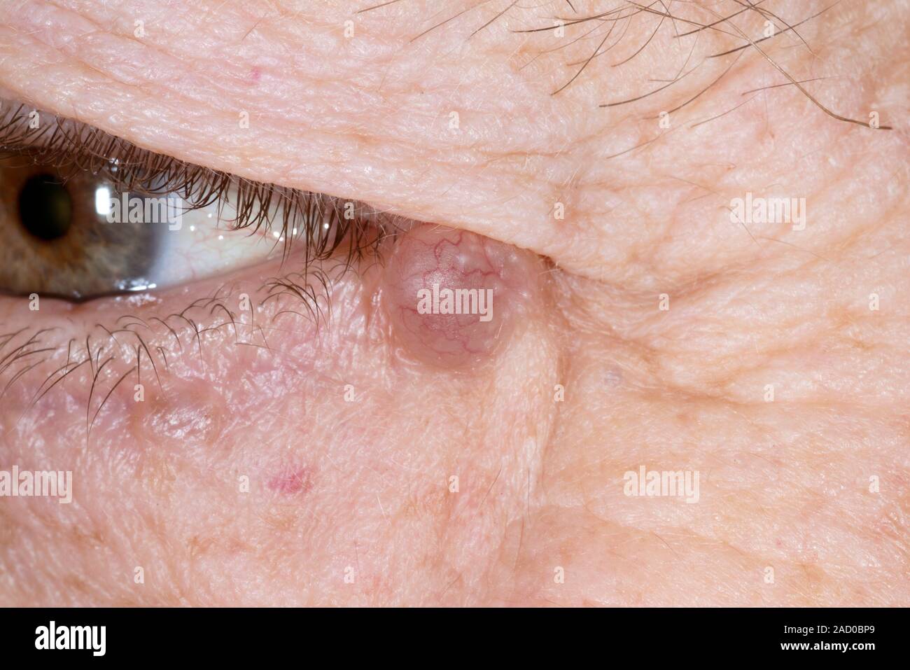Kyste de la paupière. Close-up d'un kyste au coin de l'oeil de 71-year ...