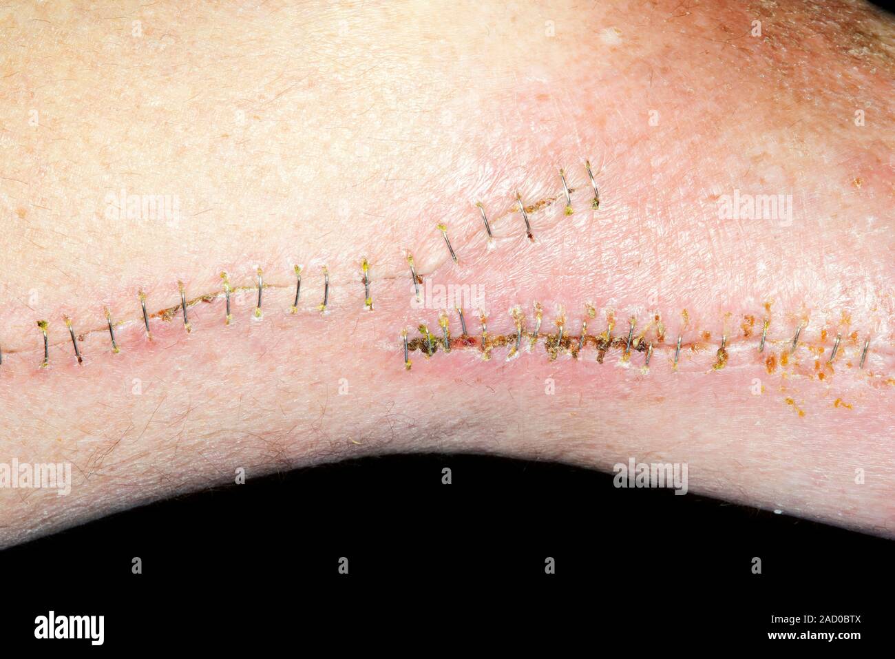 Plaies chirurgicales infectées. Close-up de plaies chirurgicales ...