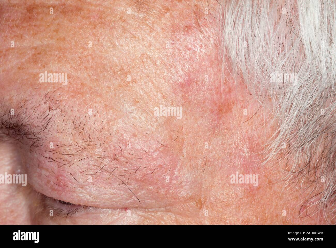 Les bardeaux. Close-up de cloques sur le front d'un 67-year-old male patient avec des bardeaux ...