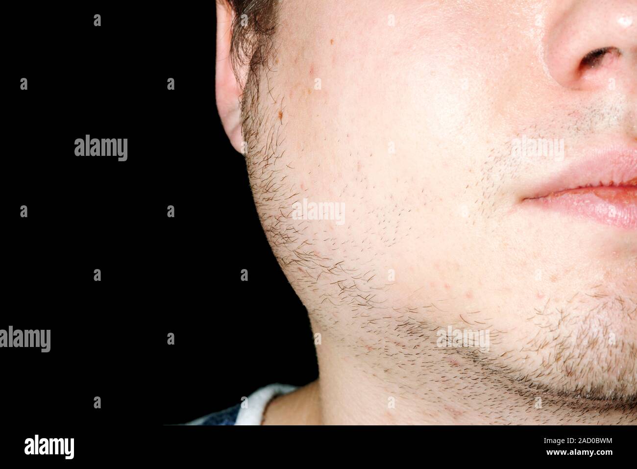 Les oreillons. Close-up du gonflement du visage d'un 19-year-old male ...