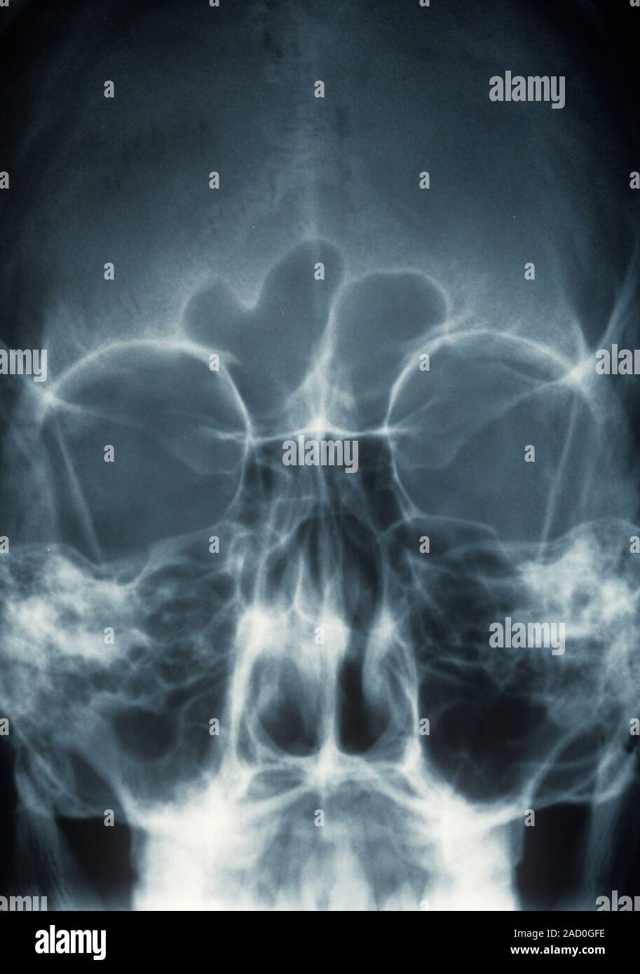 Les sinus du visage. X-ray du crâne montrant le visage des sinus. Les ...