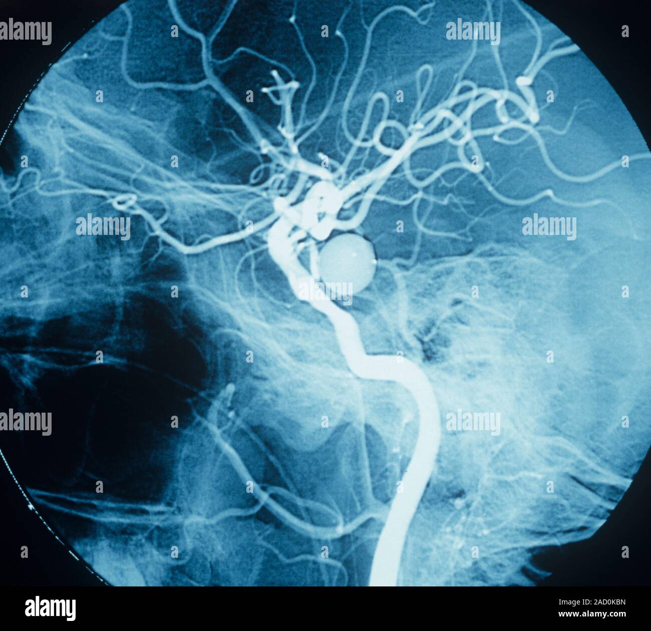 La fistule caverneuse-carotidiens traités, X-ray. D'angiographie ...