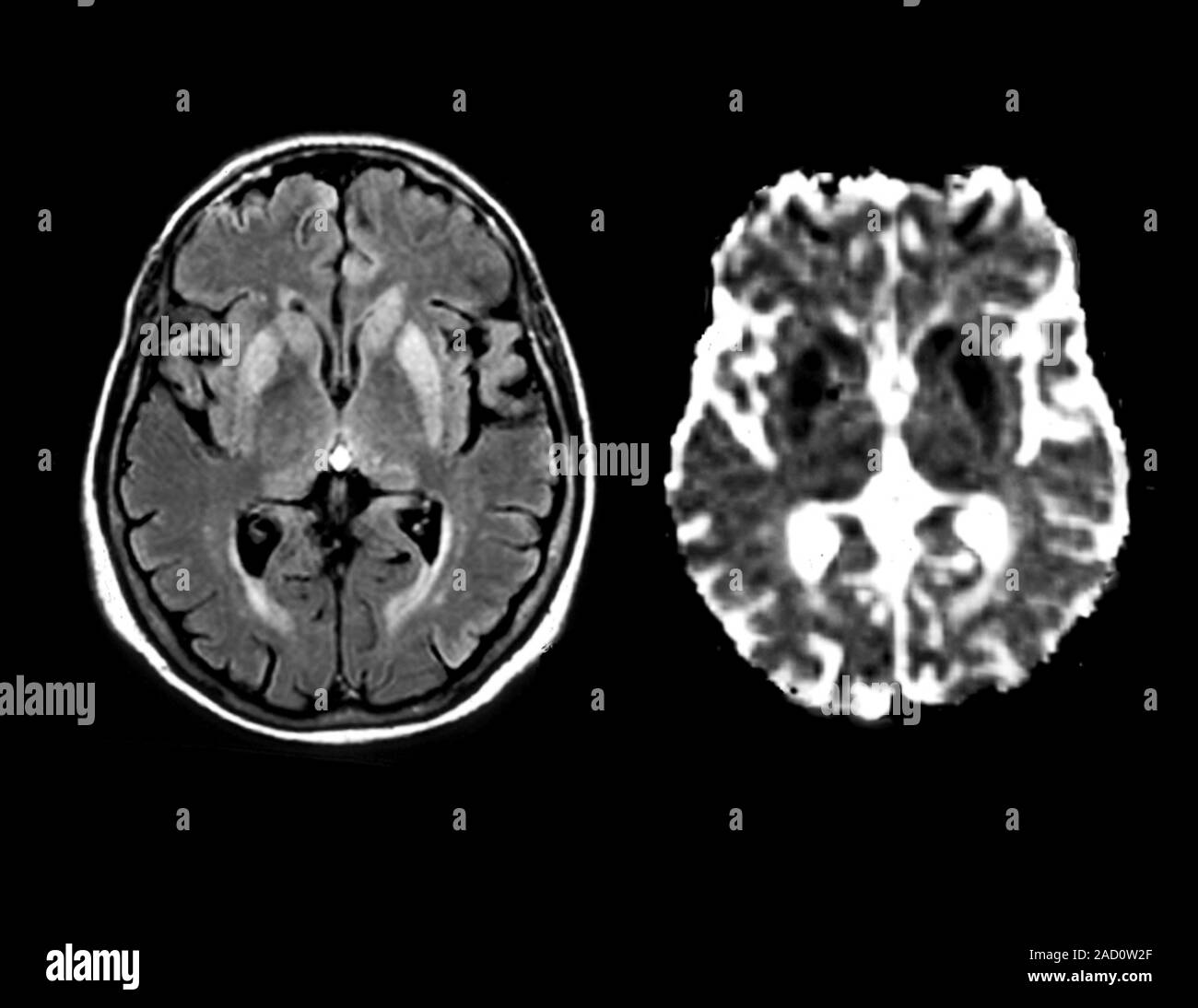 Le cerveau dans la maladie de Creutzfeldt-Jakob. FLAIR et diffusion de ...