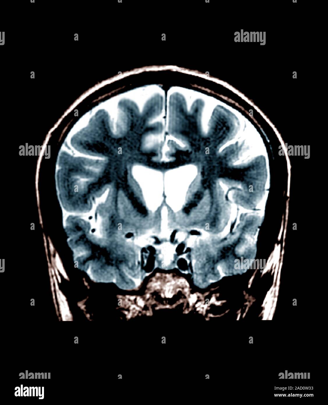 Le cerveau dans la maladie de Huntington. FLAIR l'imagerie par ...