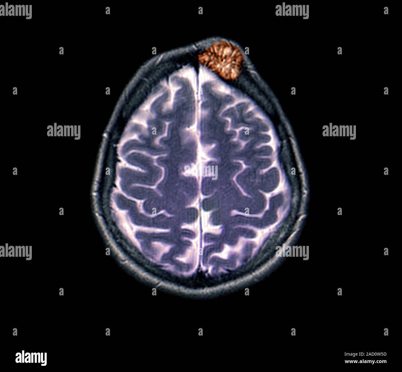 Tumeur au cerveau. L'imagerie par résonance magnétique de couleur (IRM) d'une section axiale ...