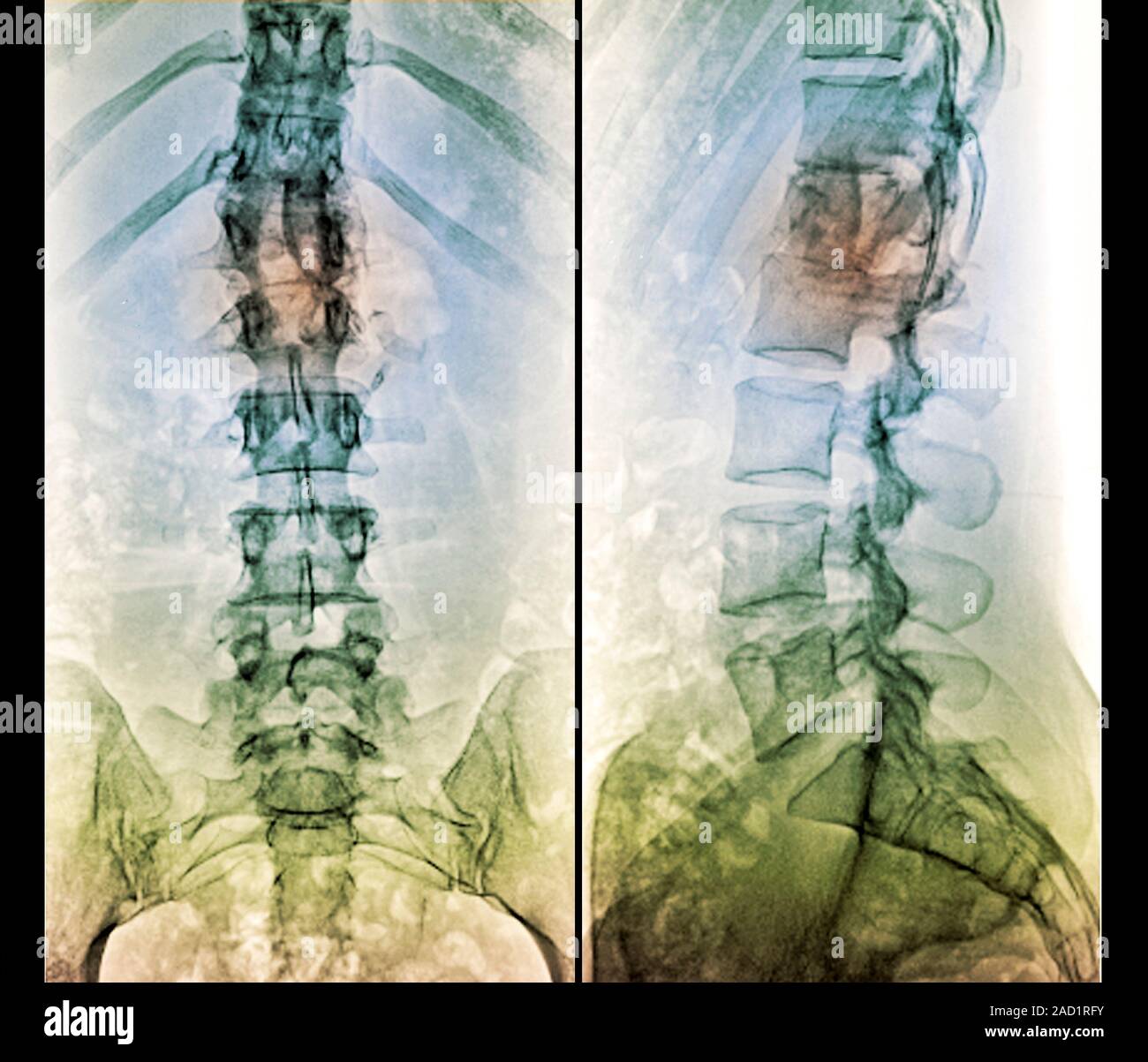 La fracture vertébrale fixe. Frontal de couleur (à gauche) et de profil ...