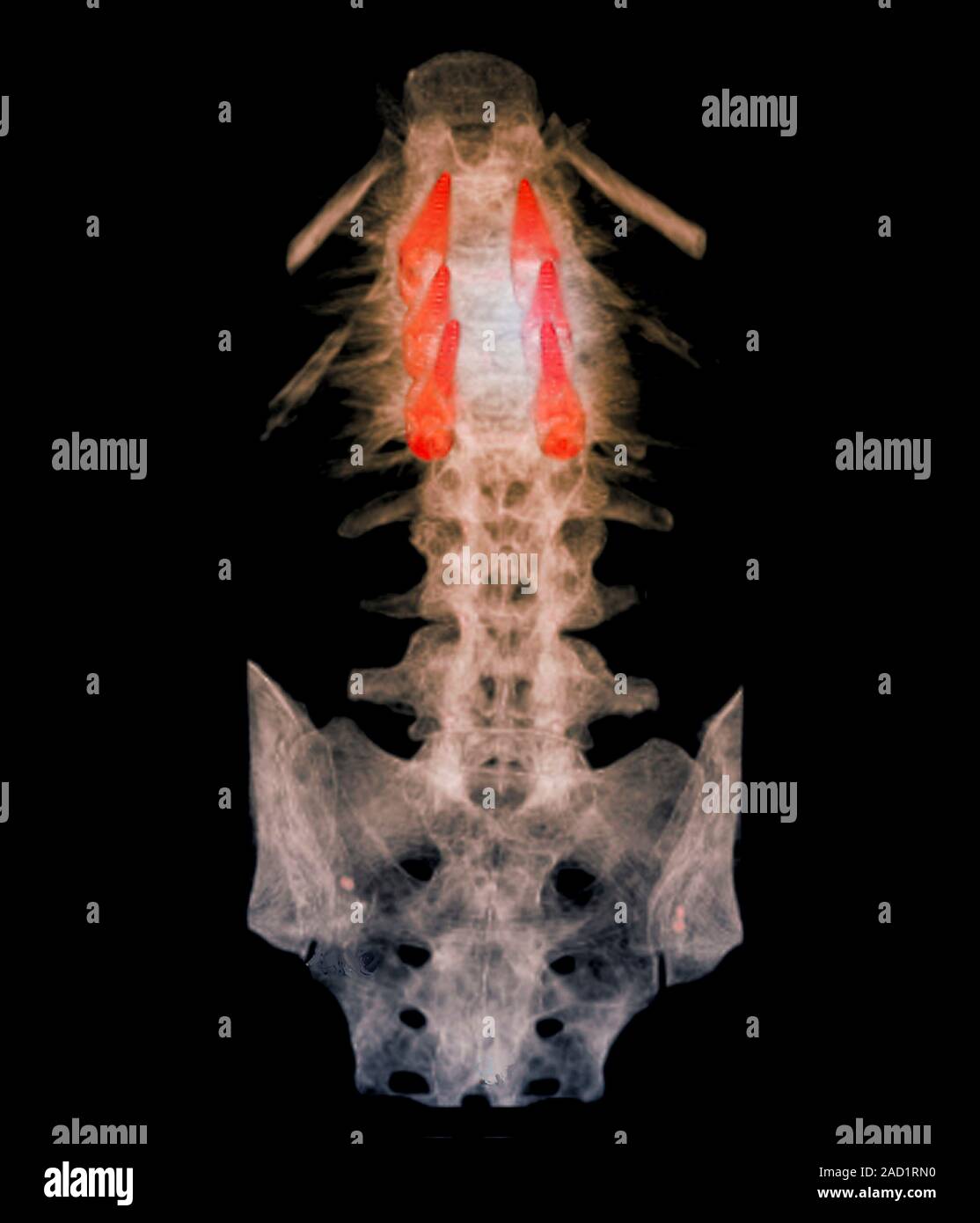 La fracture vertébrale épinglé. Frontal de couleur 3D computed ...