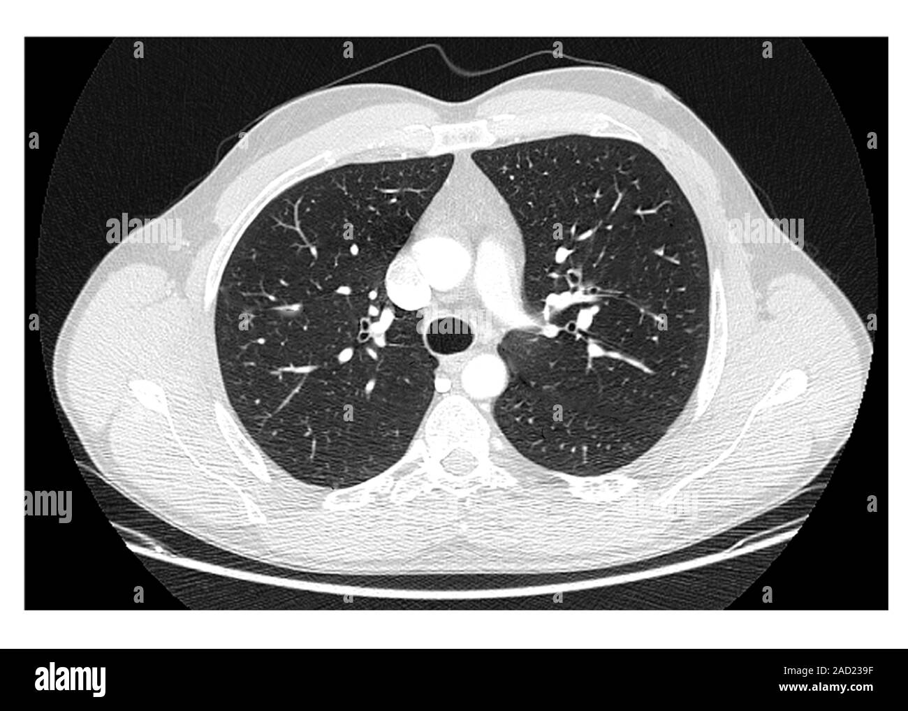 Illustration des poumons, la segmentation pulmonaire thoracique en CT ...